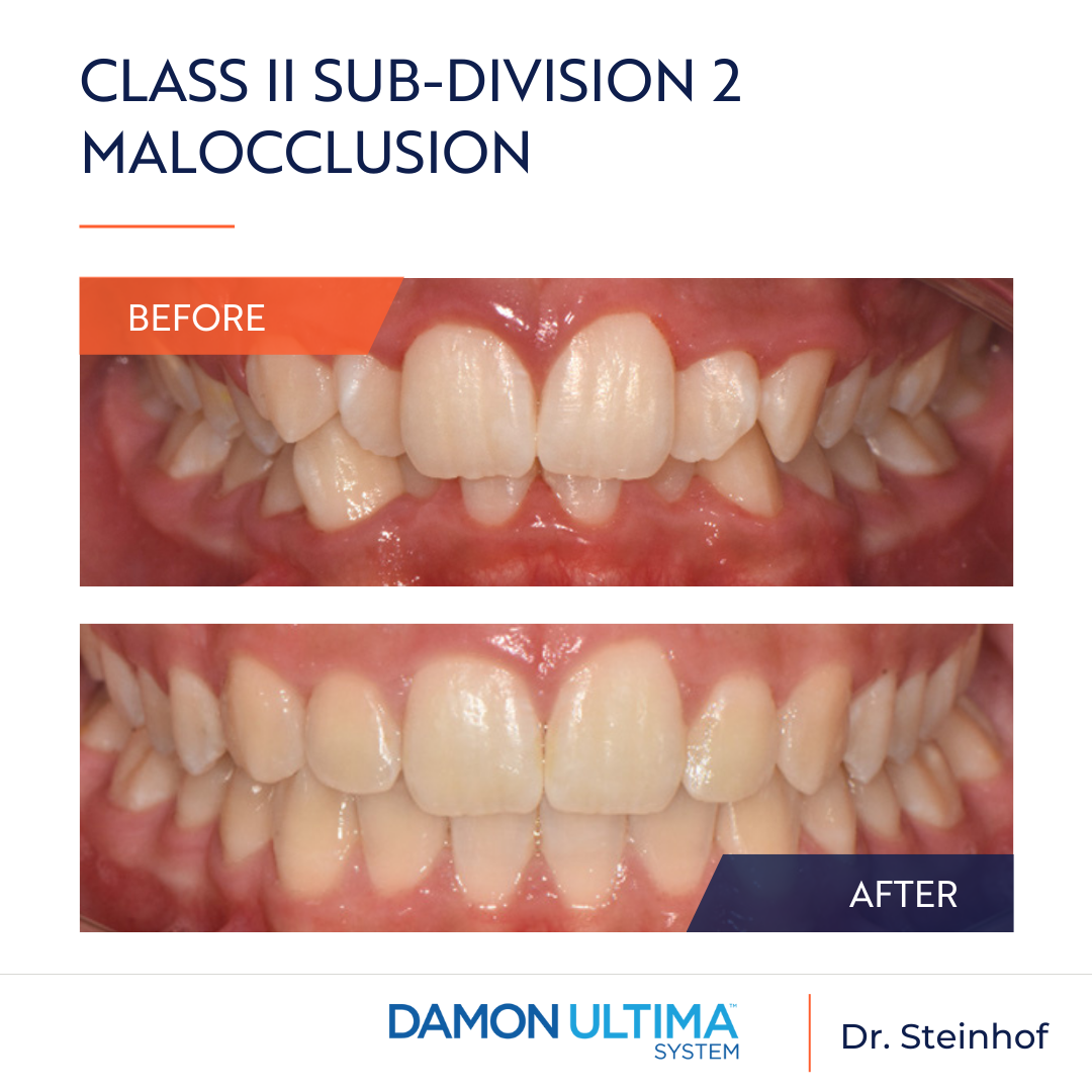 Maloclusión de Clase II subdivisión 2 con apiñamiento maxilar y mandibular significativo | Ormco
