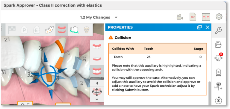 Spark™ Releases: actualizaciones nuevas de alineadores Spark